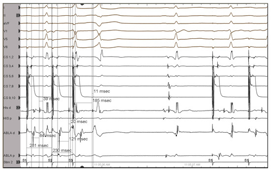 Not Just a One-Way: Mahaim Accessory Pathway Concomitantly Supporting ...