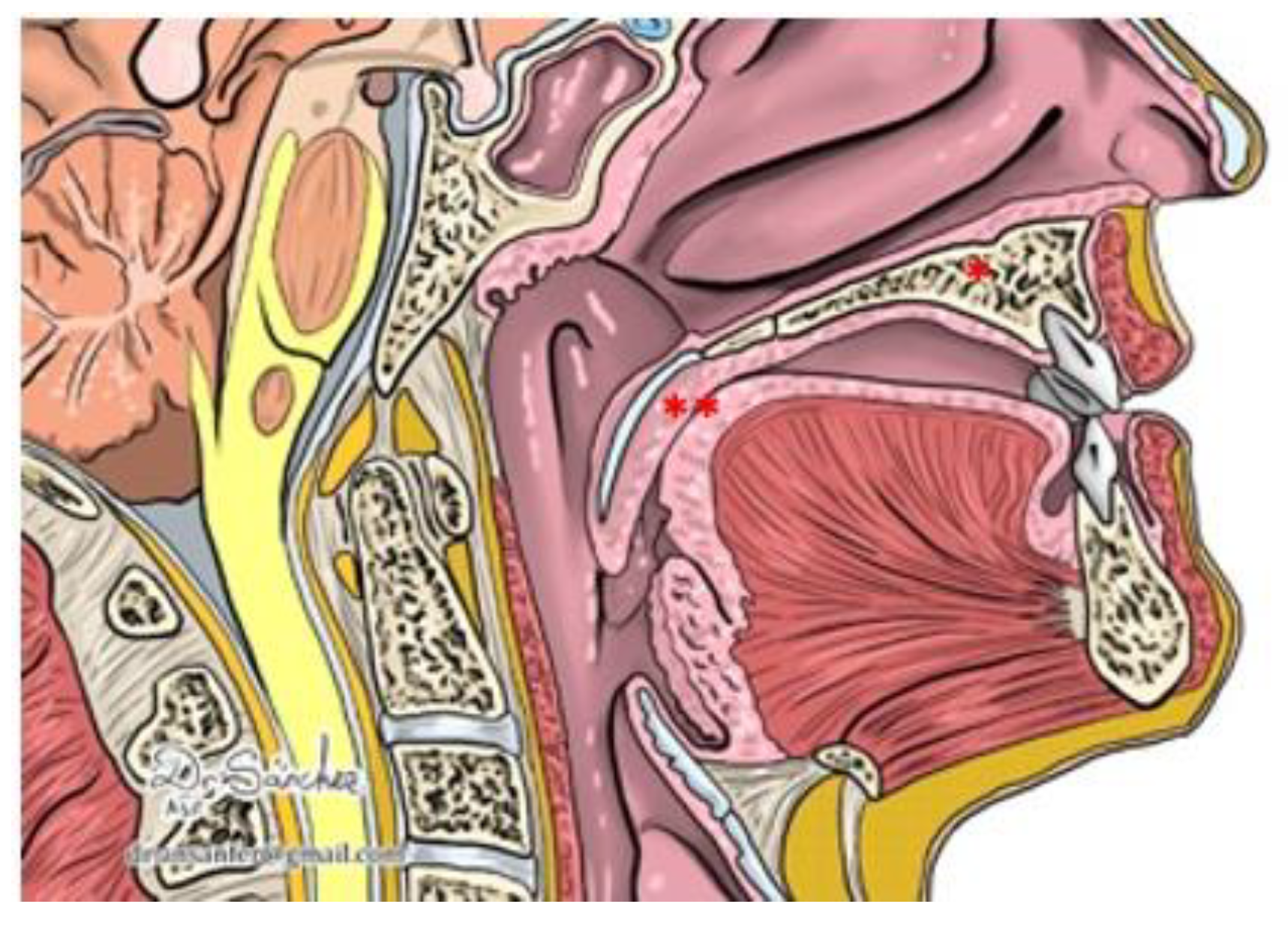 Does Frenotomy Modify Upper Airway Collapse in OSA Adult Patients? Case ...