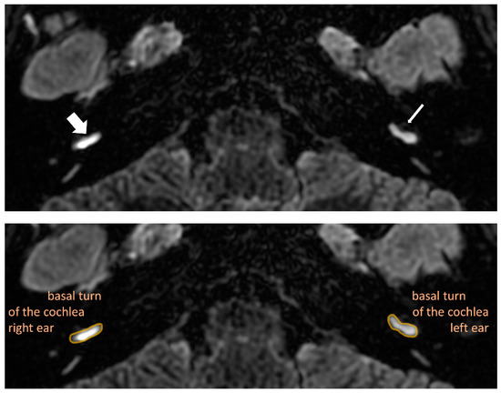 Reliability of Endolymphatic Hydrops Qualitative Assessment in Magnetic ...
