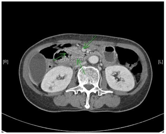 Clinical Outcome of Resected Non-Ampullary Duodenal Adenocarcinoma: A ...