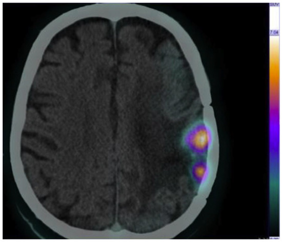 Targeting Copper in Cancer Imaging and Therapy: A New Theragnostic Agent