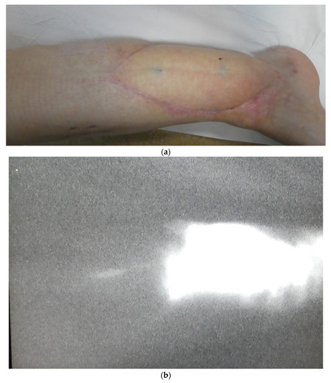 Spontaneous Lymph Flow Restoration in Free Flaps: A Pilot Study