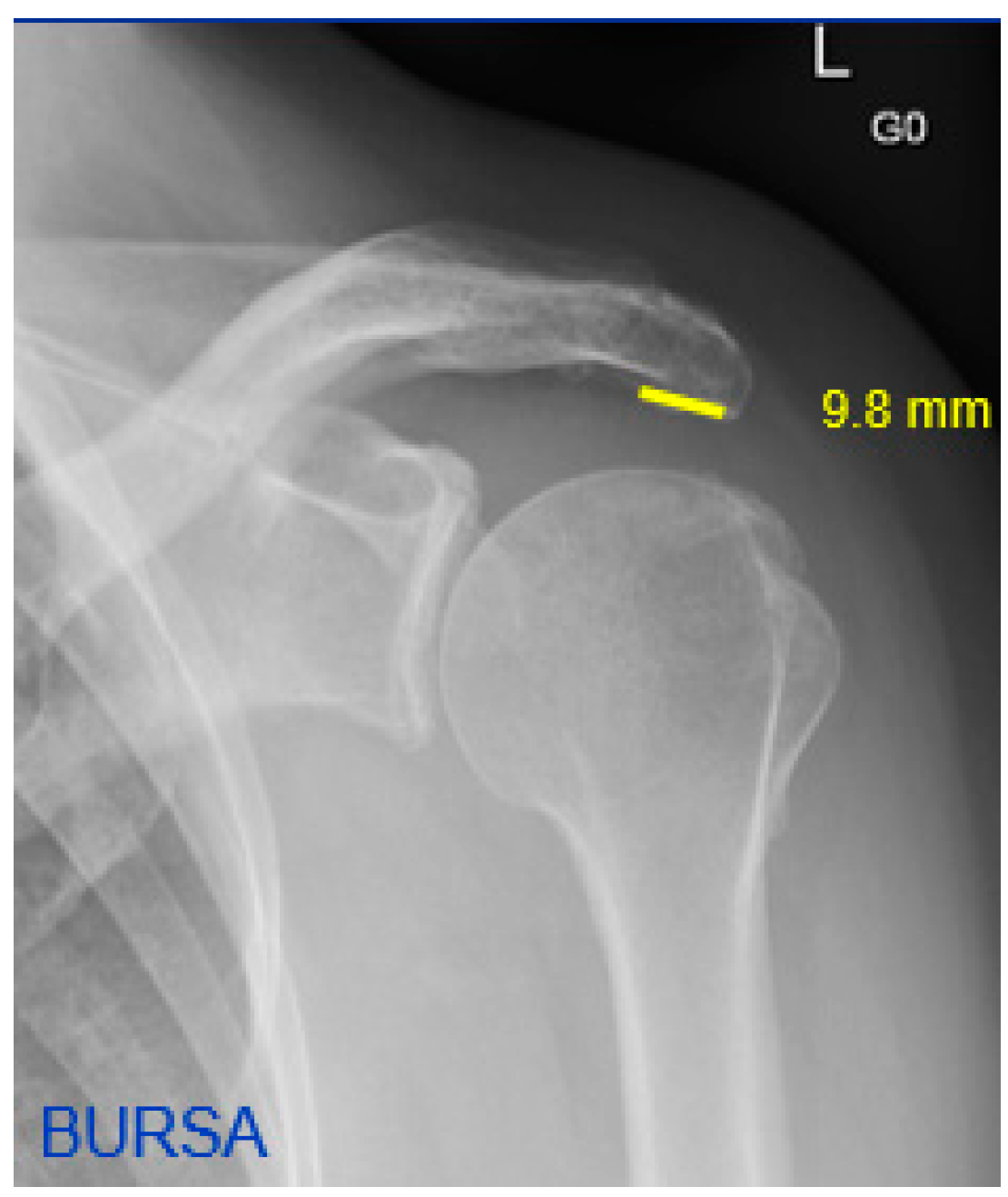 Types Of Acromion Shapes