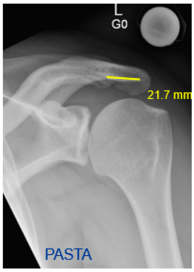 Acromial Morphology and Its Relation to the Glenoid Is Associated with ...