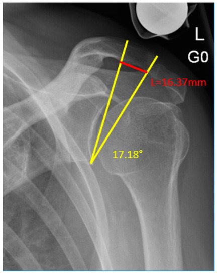 Acromial Morphology and Its Relation to the Glenoid Is Associated with ...