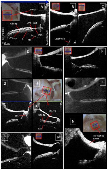 Optical Coherence Tomography-Based Atlas of the Human Cochlear Hook Region
