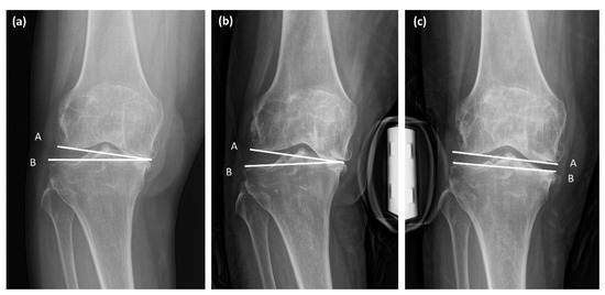 Effects of Severe Varus Deformity on Soft Tissue Balancing in Total ...