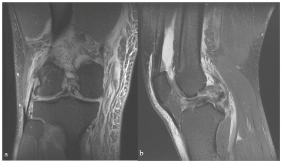 Mid-Term Results following Traumatic Knee Joint Dislocation