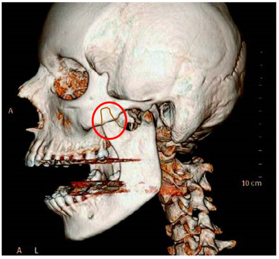 The Emergencies in the Group of Patients with Temporomandibular Disorders