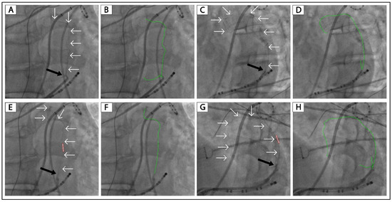 Vein of Marshall Collateralization during Ethanol Infusion in Atrial ...