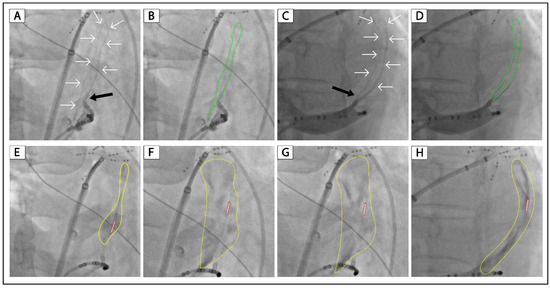 Vein of Marshall Collateralization during Ethanol Infusion in Atrial ...