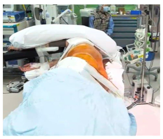 Single-Position Oblique Lumbar Interbody Fusion and Percutaneous ...