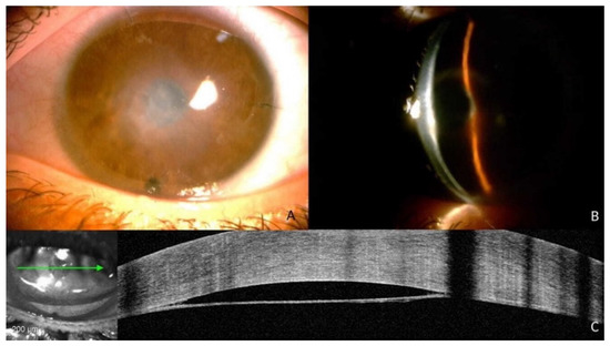 Case Report: “Spontaneous Descemet Membrane Detachment”