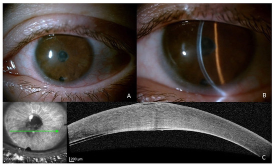 Case Report: “Spontaneous Descemet Membrane Detachment”
