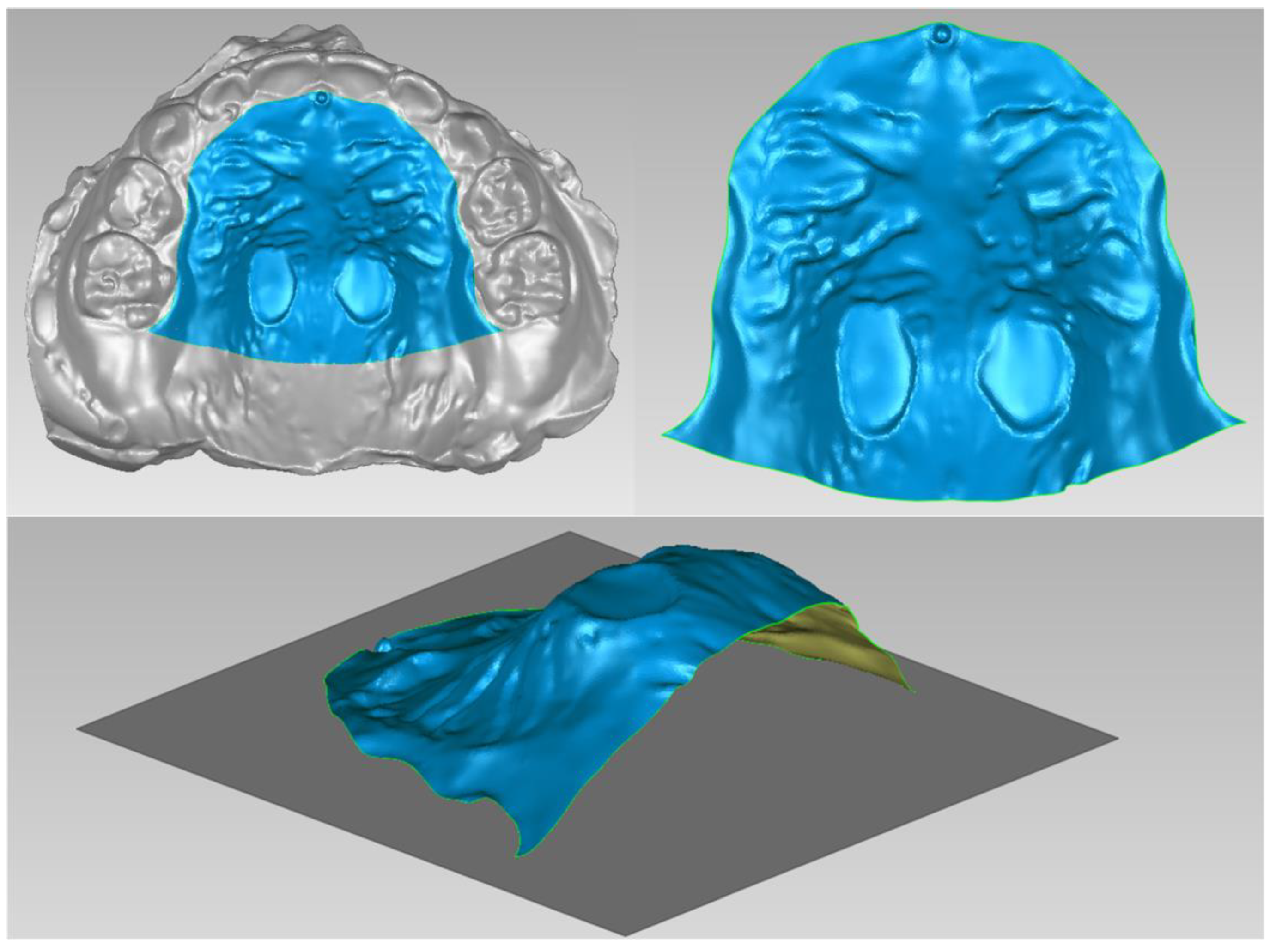 Invisalign Treatment of a Three-Year-Old Child with Bilateral Posterior ...