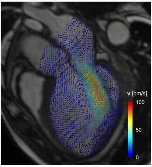 Left Ventricular Adverse Remodeling in Ischemic Heart Disease: Emerging ...