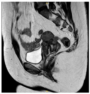 HRT in Women Undergoing Pelvic Clearance for Endometriosis—A Case ...