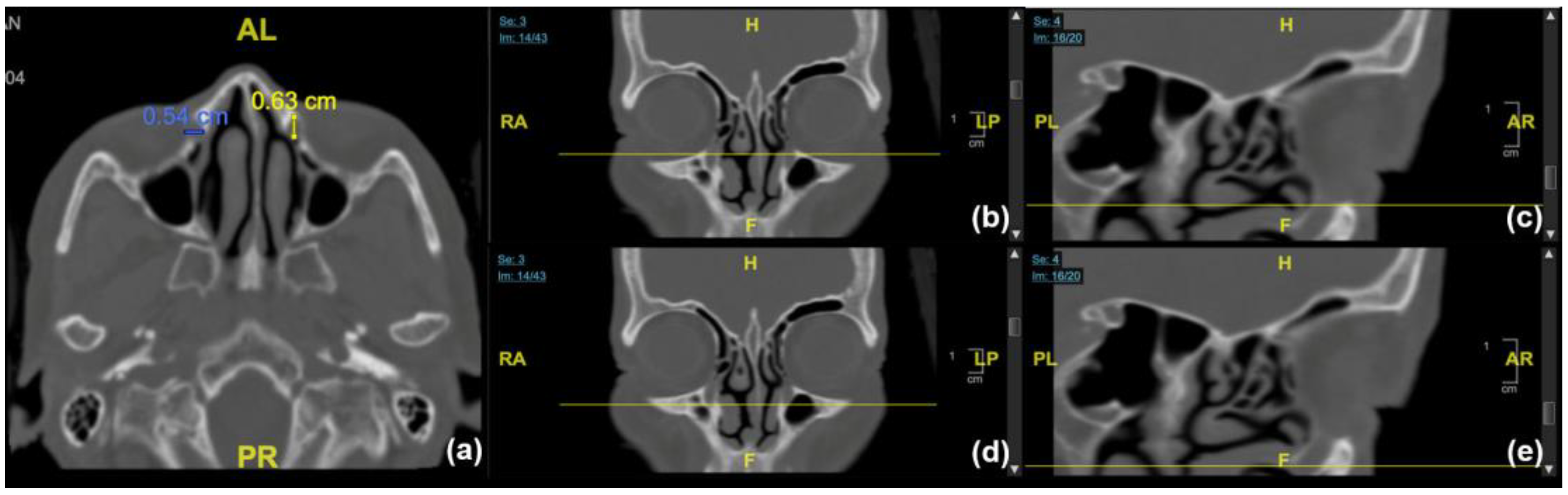 Nasolacrimal Canal Radiograph