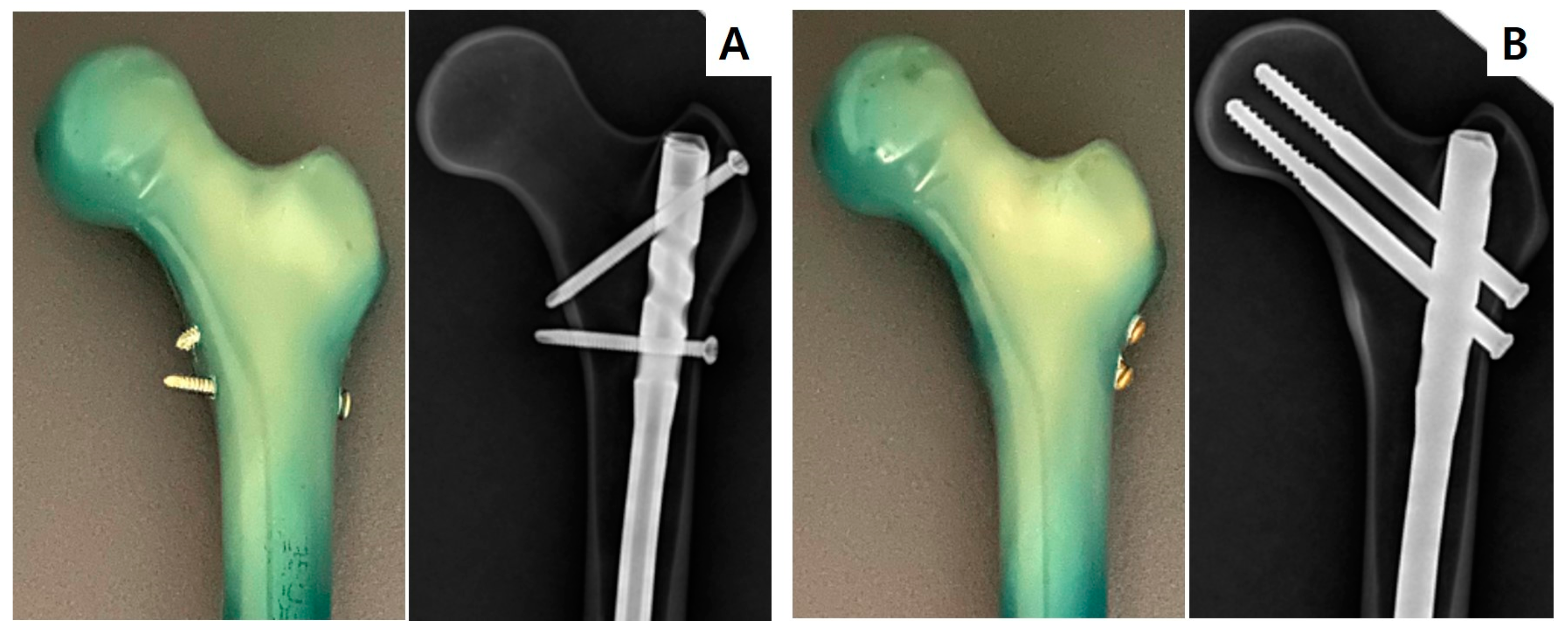 Prophylactic Femoral Neck Fixation in an Osteoporosis Femur Model: A ...