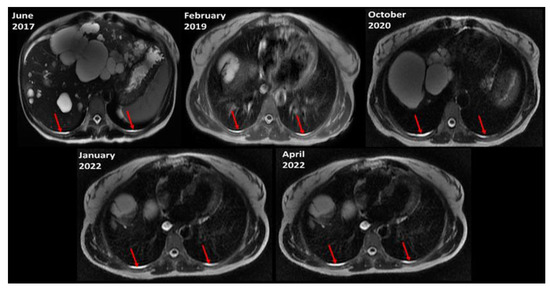 Pleural Effusions on MRI in Autosomal Dominant Polycystic Kidney Disease