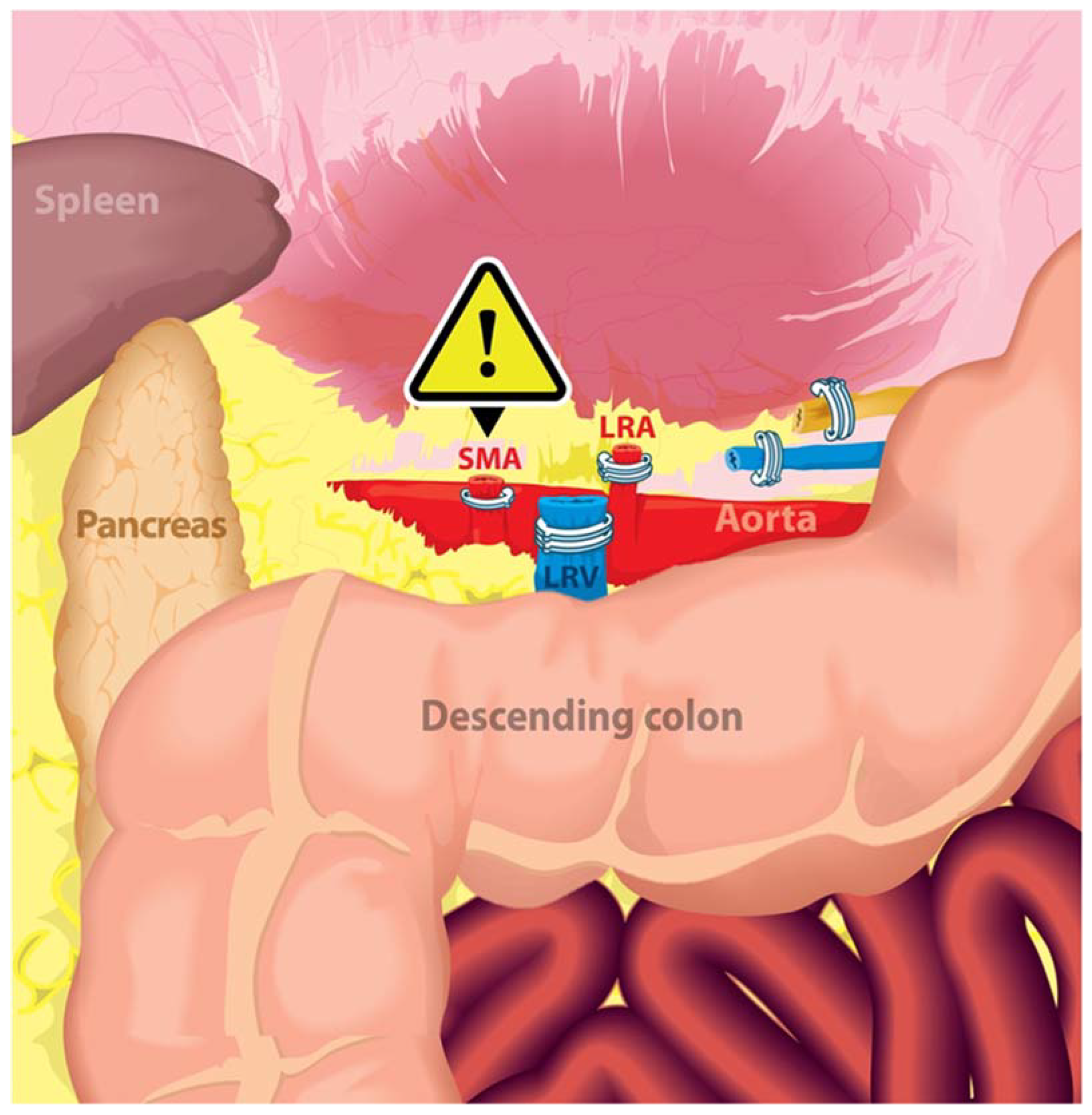 Superior Mesenteric Artery Injury during Robotic Radical Nephrectomy ... Superior Mesenteric Artery Injury during Robotic Radical Nephrectomy ...