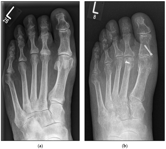 The Conventional Weil Osteotomy Does Not Require Screw Fixation