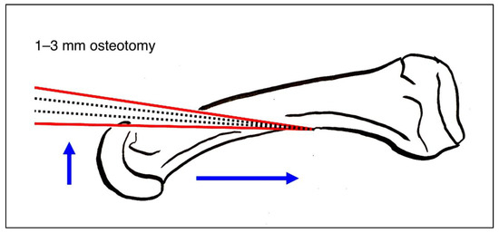 The Conventional Weil Osteotomy Does Not Require Screw Fixation