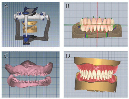 Digital versus Conventional Dentures: A Prospective, Randomized Cross ...