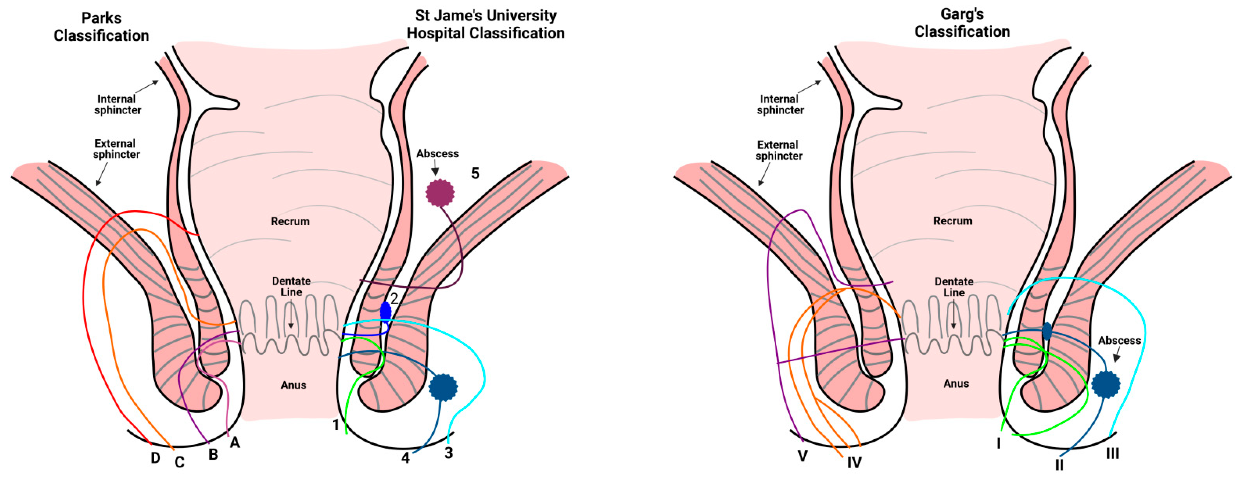 Perianal Fistula Classification Perianal Fistula Classification