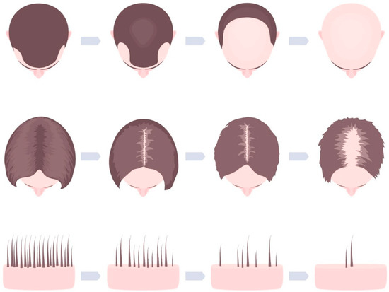 A Novel Hair Restoration Technology Counteracts Androgenic Hair Loss and Promotes Hair Growth in A Blinded Clinical Trial