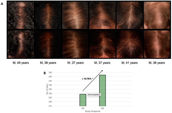 A Novel Hair Restoration Technology Counteracts Androgenic Hair Loss ...