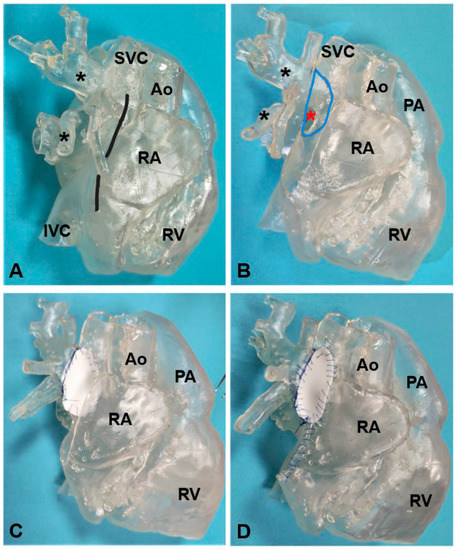 Three-Dimensional-Enabled Surgical Planning for the Correction of Right ...