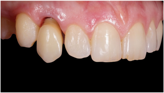 Immediate vs. Delayed Placement of Immediately Provisionalized Self ...