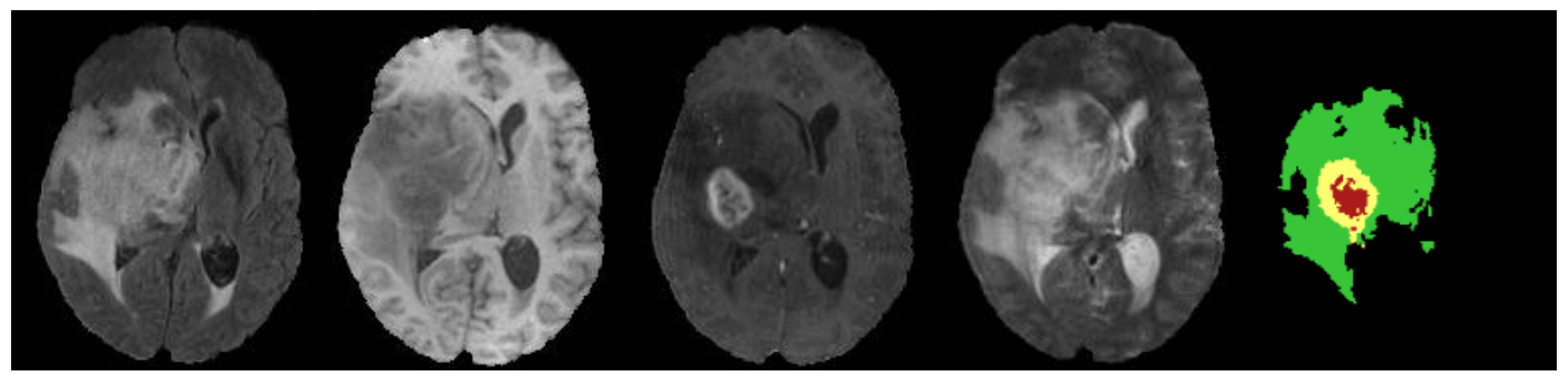JCM | Free Full-Text | HMNet: Hierarchical Multi-Scale Brain Tumor Segmentation Network