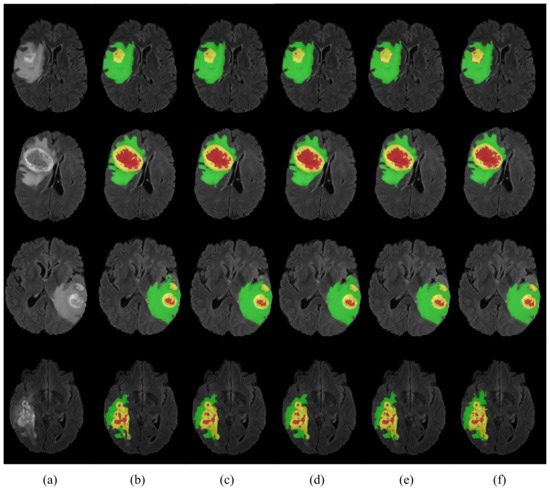 HMNet: Hierarchical Multi-Scale Brain Tumor Segmentation Network
