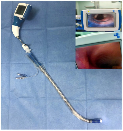 A Randomized Study of Rigid Video Stylet versus Macintosh Laryngoscope ...