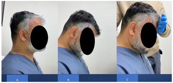 A Comparison of Two Forward Head Posture Corrective Approaches in ...