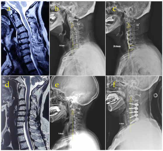Anterior and Posterior Approaches for 4-Level Degenerative Cervical ...