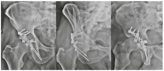 Spring Plates as a Valid Additional Fixation in Comminuted Posterior ...