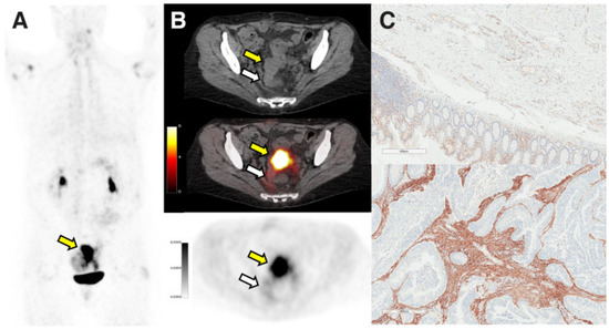 FAPI PET/CT in Diagnostic and Treatment Management of Colorectal Cancer ...