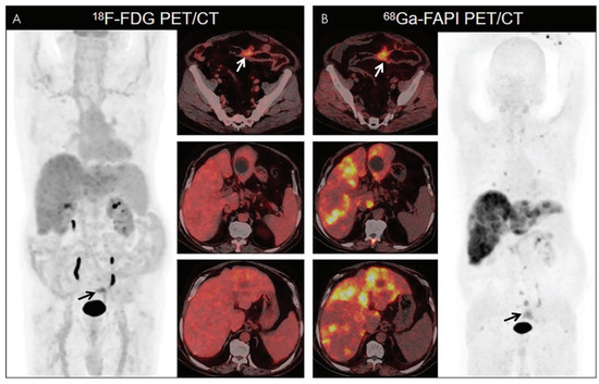 FAPI PET/CT in Diagnostic and Treatment Management of Colorectal Cancer: Review of Current ...