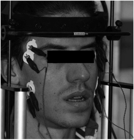 Evaluation of Masticatory Muscles in Adult Patients with Maxillary ...