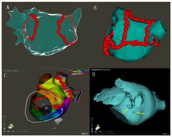 Efficacy and Safety Ablation Index-Guided High-Energy Linear Ablation ...