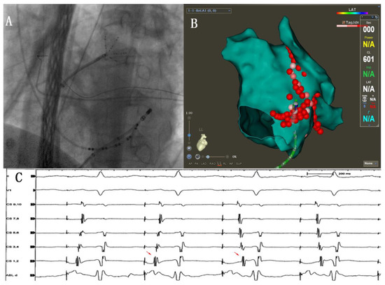 JCM | Free Full-Text | Efficacy and Safety Ablation Index-Guided High ...