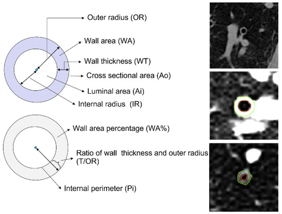 Quantitative CT Metrics for the Prediction of Therapeutic Effect in Asthma
