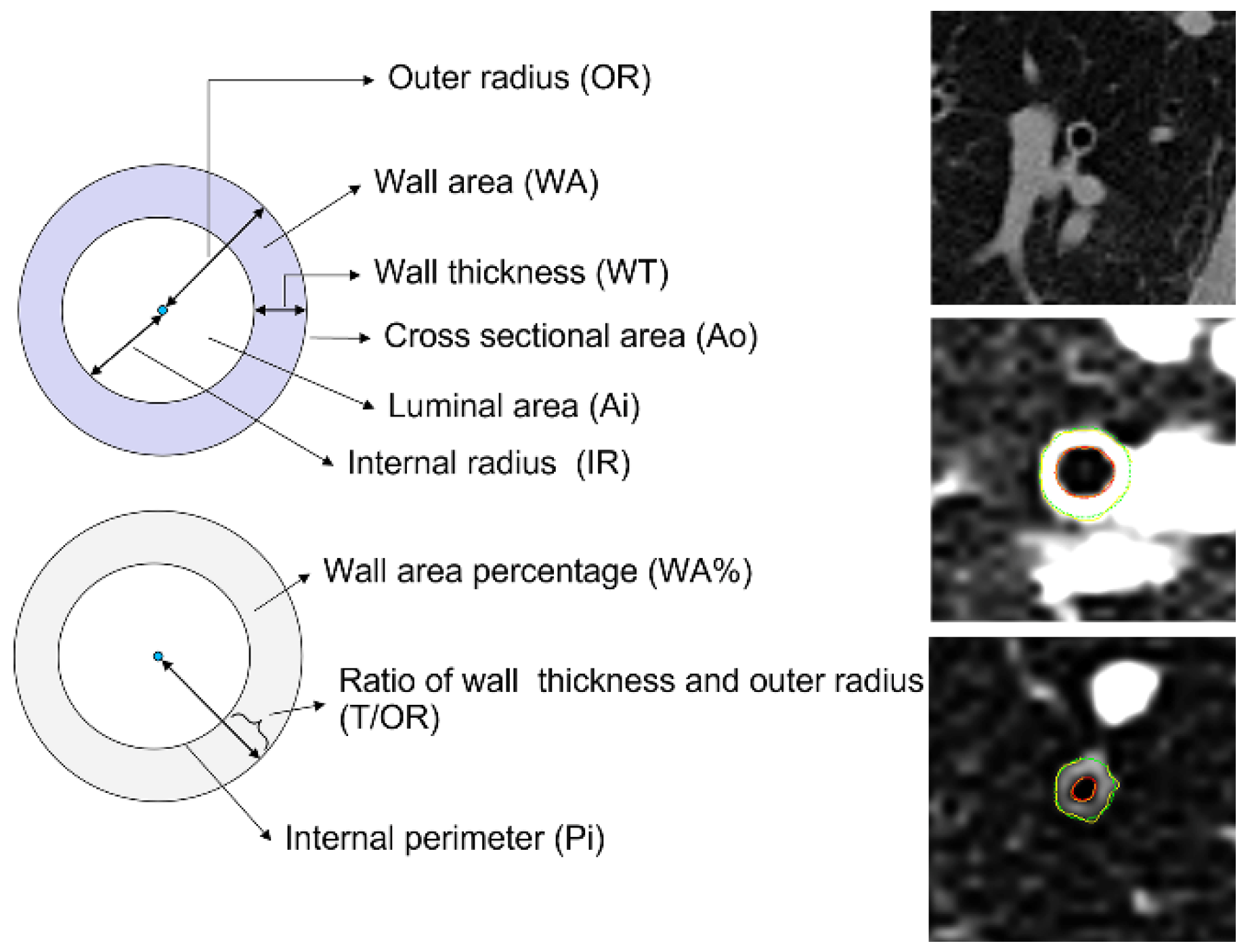 JCM | Free Full-Text | Quantitative CT Metrics for the Prediction of ...