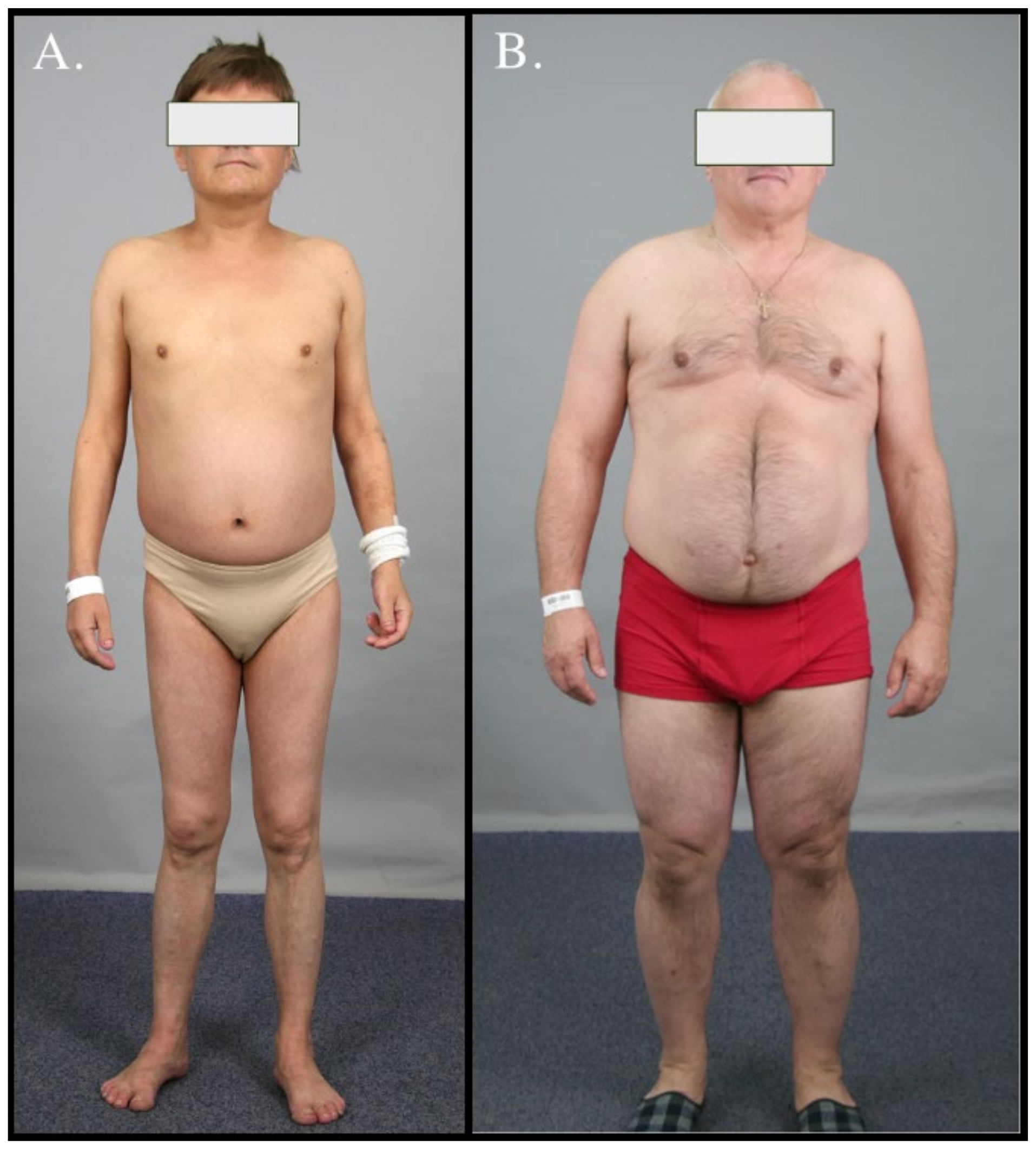 Jcm Free Full Text Characteristics Of Congenital Adrenal