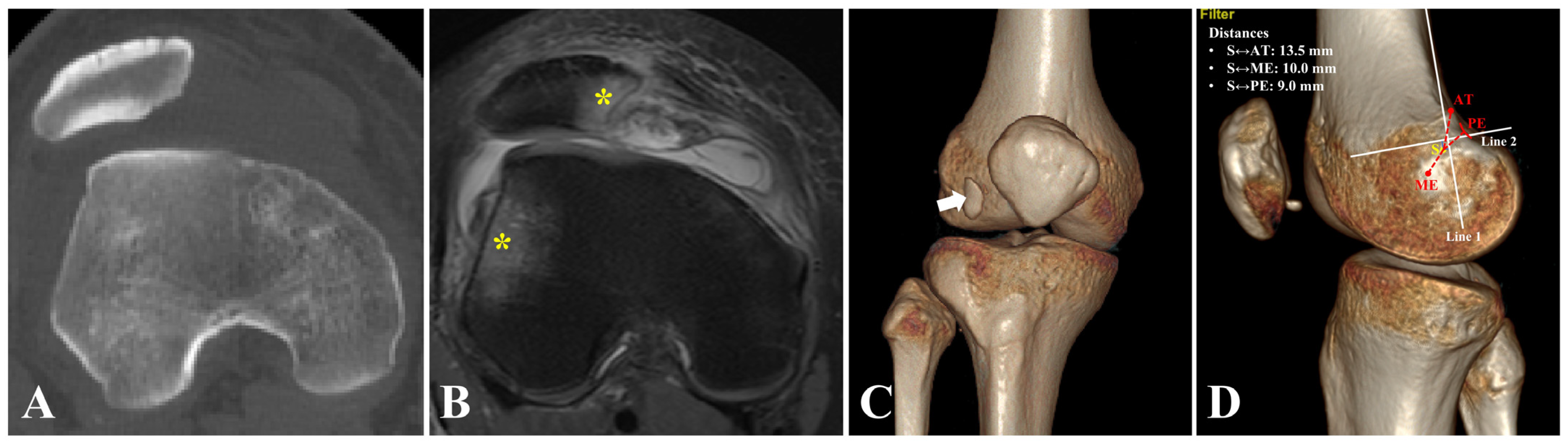 Jcm Free Full Text A Novel Technique Of Arthroscopic Femoral Tunnel