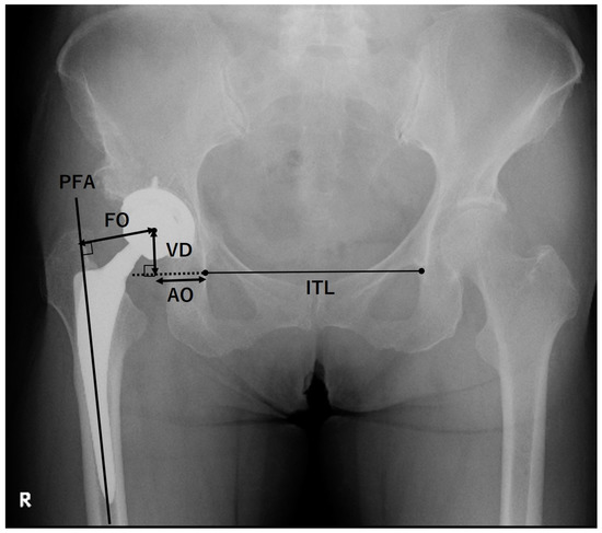 JCM | Free Full-Text | Clinical Outcomes for Total Hip Arthroplasty ...