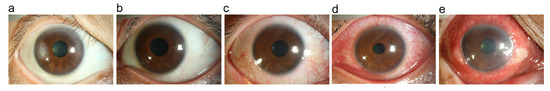 Developing a Deep Learning Model to Evaluate Bulbar Conjunctival ...
